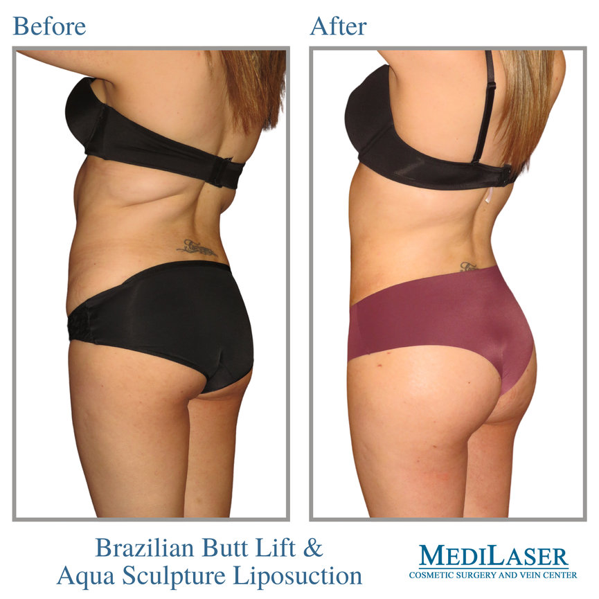 Brazilian Butt Lift Before and After - Medilaser Surgery and Vein Center