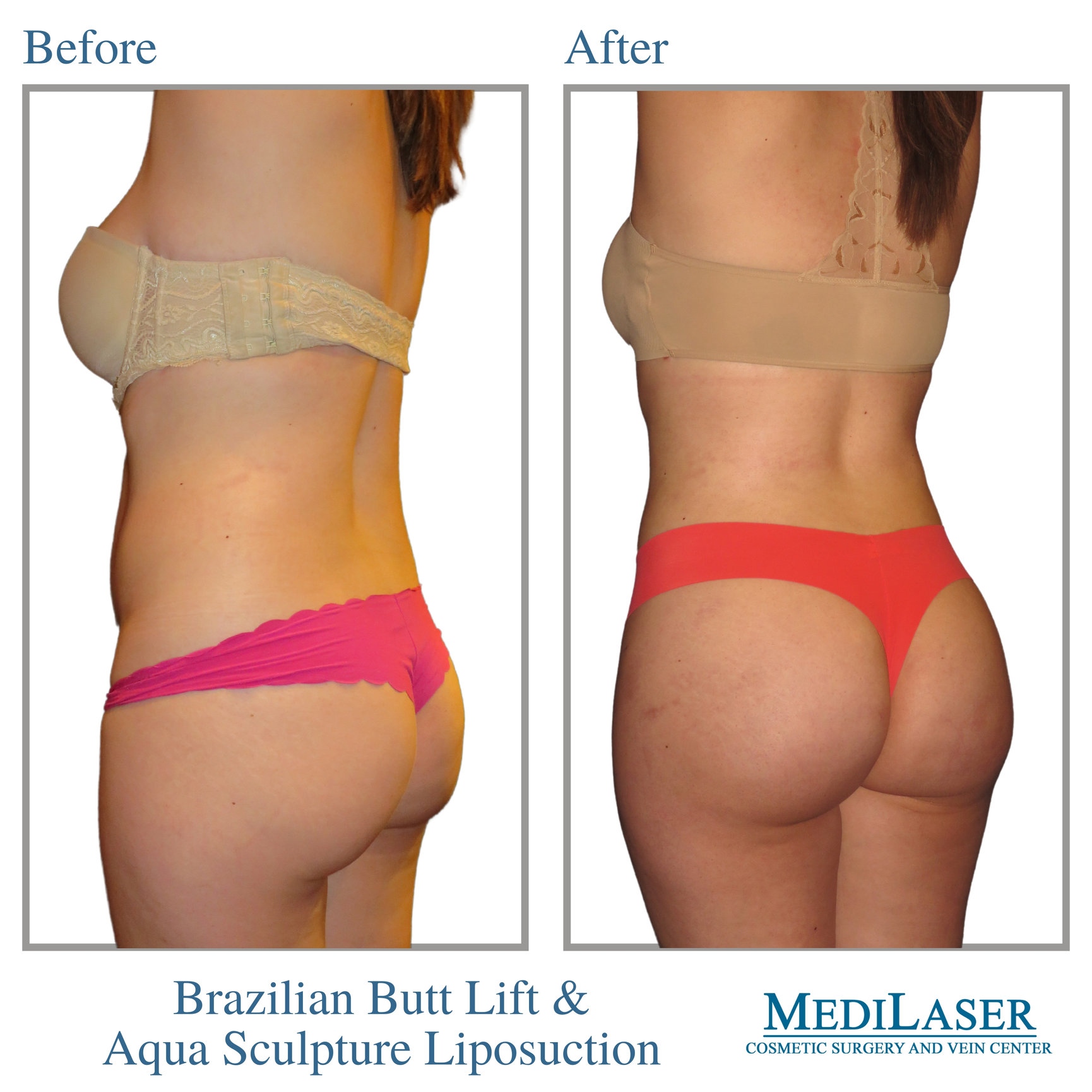 BBL Before & After | Medilaser | Frisco, TX